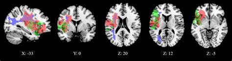 Manually Segmented Lesion Location For P4 Red P6 Blue And P10 Download Scientific Diagram