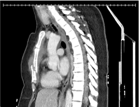 Ct Chest Of Sternal Fracture Ct Imaging Demonstrating Our Patients Download Scientific