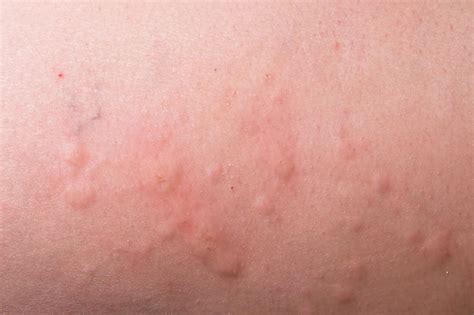 Itchy Rashes Chronic Hives Care Knowing When And How To Soothe The