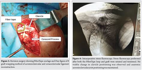 Failed Loop Endobutton Acromioclavicular Joint Reconstruction Treated With Duo Figure Of 8