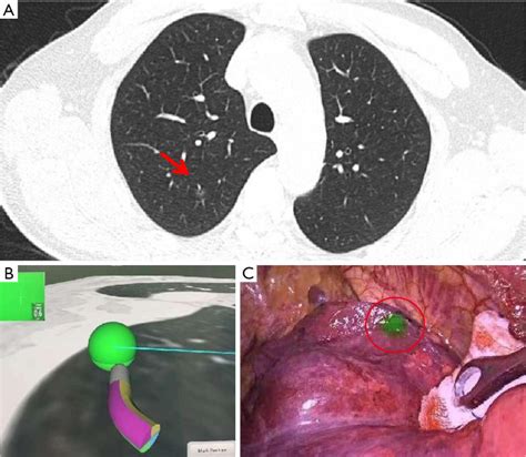 Localization Strategies For Deep Lung Nodule Using Electromagnetic Navigation Bronchoscopy And