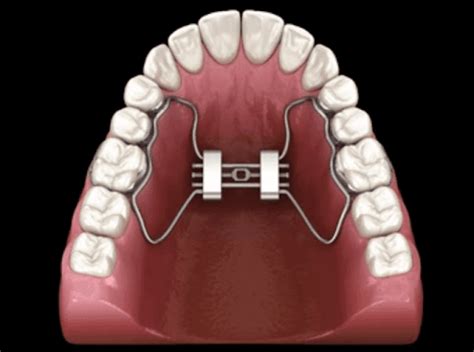 What Is A Palatal Expander White Plains Orthodontics