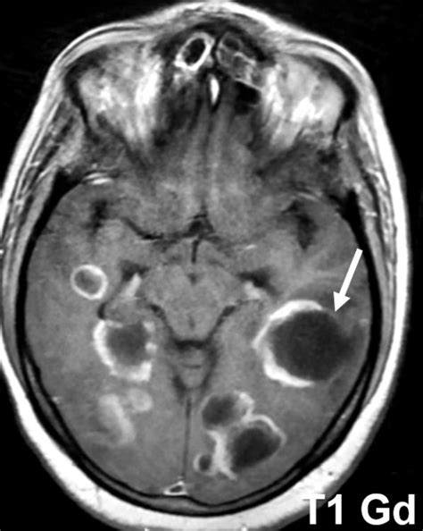 Classic Case American Journal Of Neuroradiology