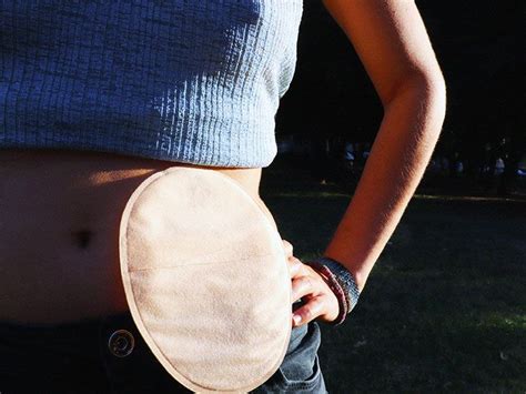 Loop Colostomy Uses And Procedure