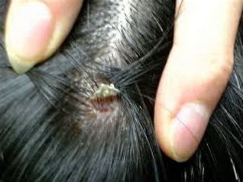 Red Bumps On Scalp Small Itchy Bumps On Scalp Painful Vrogue Co