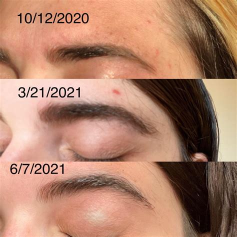 Been On A Journey Of Fading My Micro Blading While Also Recovering From Trichotillomania