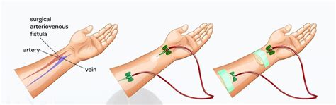 What Is Av Fistula Surgery