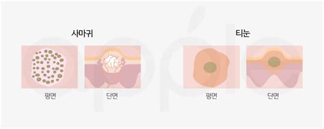 사마귀 티눈 애플피부과의원