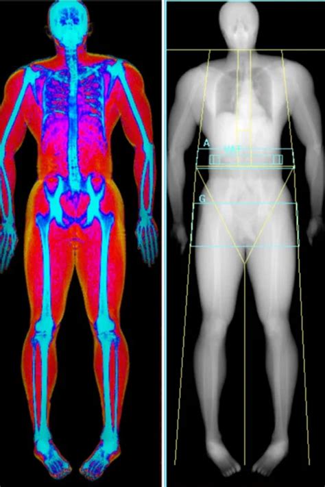 Dexa Scan Nebraska Weight And Wellness