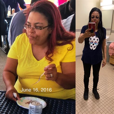 Before And After Gastric Bypass Surgery So Happy I Made The Right