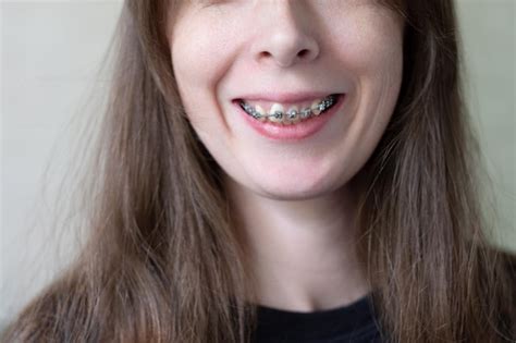 Premium Photo Womans Smile With Dental Braces To Correct An Overbite Close Up Correcting