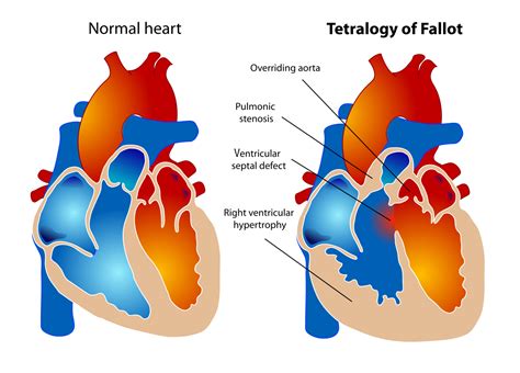 Tetralogy Of Fallot Wikipedia