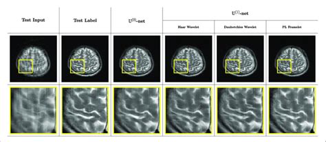 Qualitative Comparison Of The Proposed Method For Undersampled Mri Download Scientific Diagram