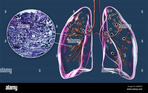 Illustration Depicting Lungs Affected By Silicosis Revealing Dark
