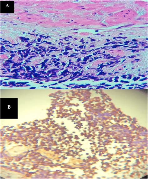 A Histology Showing Sheets Of Multinucleated Cells In Addition To Download Scientific Diagram