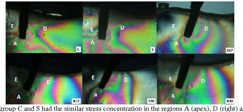 Figure 1 From Stress Analysis Of Mandibular Full Fixed Prothesis Supported By Three Implants