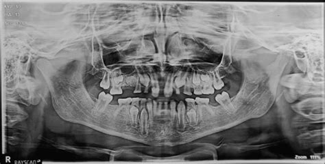Ectodermal Dysplasia A Case Report Adesh University Journal Of