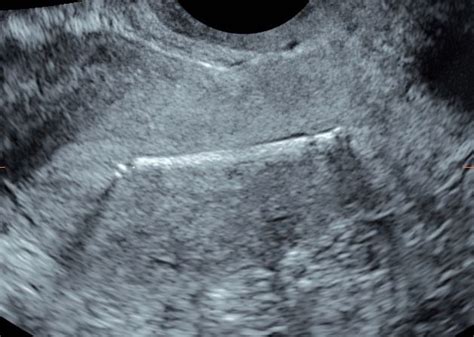 Mirena Ultrasound Appearance