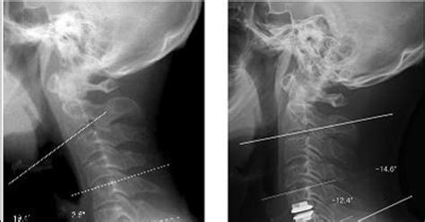 목디스크 수술 때 인공 디스크가 더 효과적