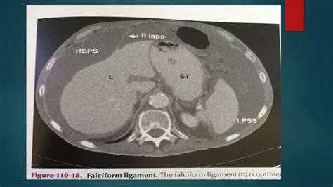 Anatomy Of Peritoneal Spaces Pptx