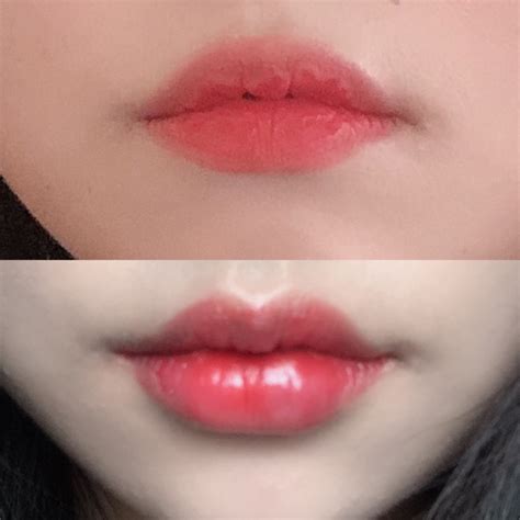 입술필러입꼬리보톡스첫시술 Community 닥터소녀로