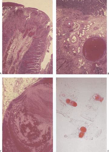 Ischemic Enteritis Abdominal Key