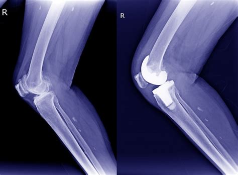 Premium Photo X Ray Right Osteoarthritis Of Knee Oa And Post Operation Total Knee