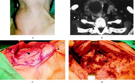 Acute Suppurative Thyroiditis Journal Of The American College Of Surgeons