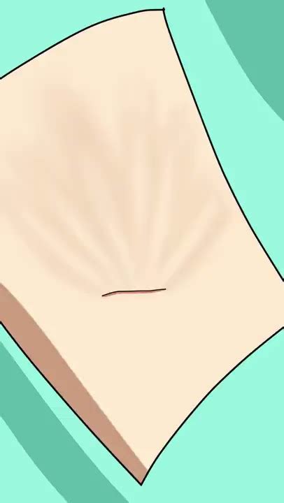 Subcutaneous implantation contraception皮下埋植避孕 YouTube