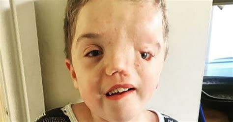 Everything Patients Need To Know About Goldenhar Syndrome