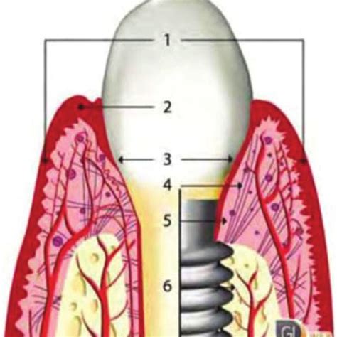Pdf Biological Width And Aesthetics In Implants