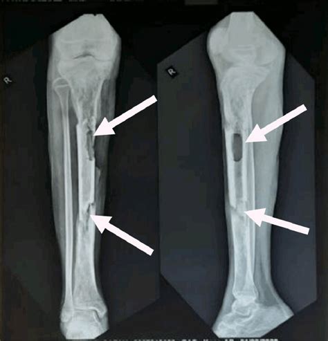 Early Physiotherapy As An Adjunct To Surgical Approach In Case Of