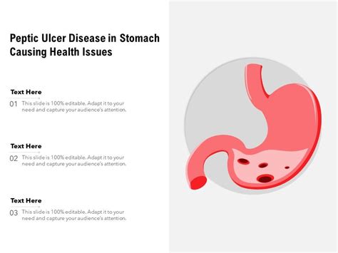 Peptic Ulcer Disease In Stomach Causing Health Issues Ppt Powerpoint Presen