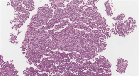 Ewings Sarcoma Ottawa Atlas Of Pathology