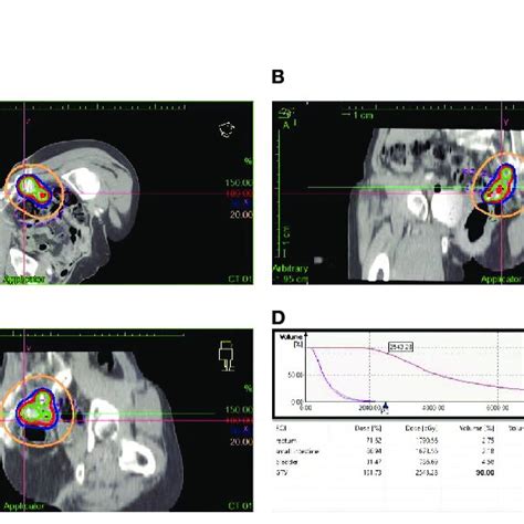 Three Dimensional Conformal Dose Assessment For Interstitial Bt A Download Scientific