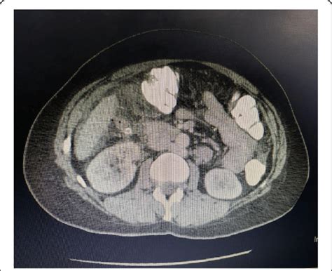 Computed Tomographic Images Showing Perforated Subhepatic Appendicitis Download Scientific