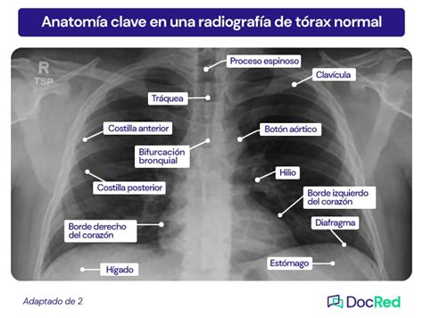 Descripcion De Radiografia De Torax Image To U