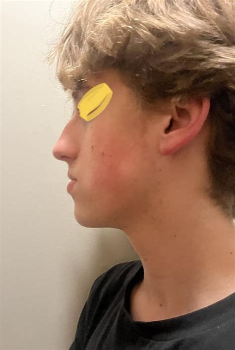 Thinking About Ujs For Underbite R Jawsurgery