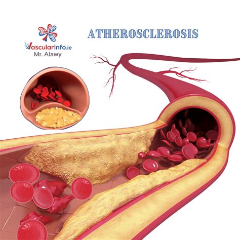 Mesenteric Ischemia Vascular Info