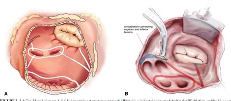 Figure 2 From The Cox Maze Procedure What Lesions And Why Semantic
