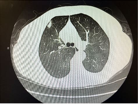 Video Atlas Of Pulmonary Segmentectomy Robotic Assisted Right S3