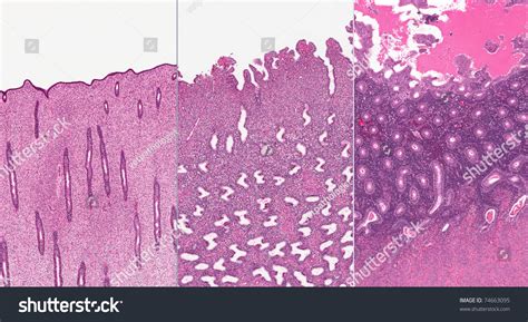 Histology Of The Human Endometrium During The Normal Cycle