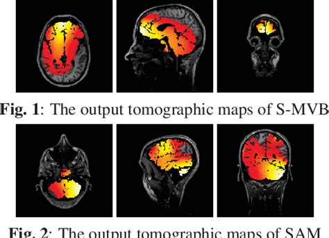 Figure 1 From Novel Beamformers For Multiple Correlated Brain Source Localization And