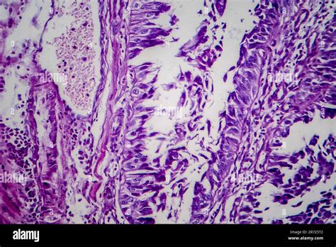 Transitional Cell Carcinoma