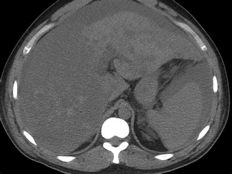 Liver Atlas Diagnosis Angiosarcoma