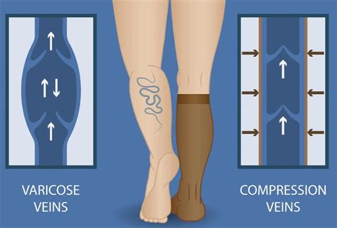 What Does 20 30 Mmhg Mean In Compression Socks Understanding Medium Pressure