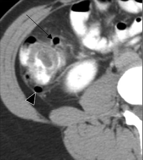 Year Old Man With Cecal Diverticulitis Helical Ct After Oral And Iv
