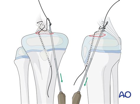 Suture Fixation For Avulsion Of The Tibial Spine