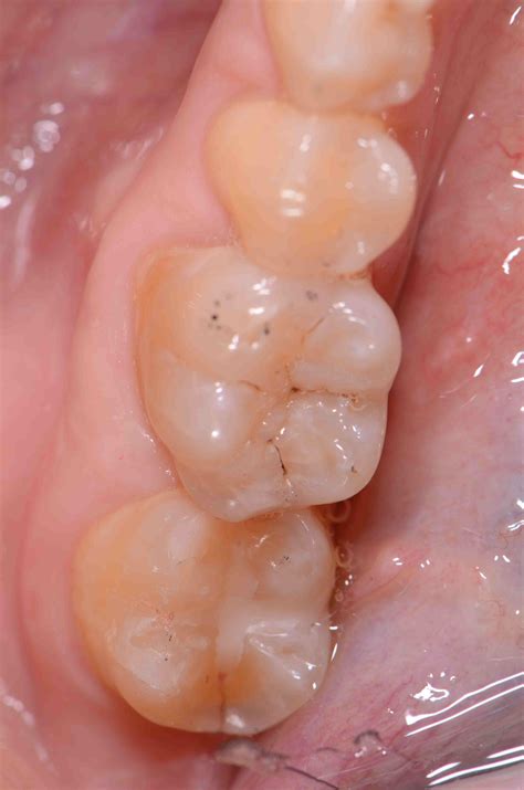 Do Patients Para Function In Centric Relation Lee Ann Brady Dmds