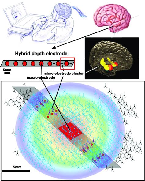 Intracranial Patient Recordings With Hybrid Depth Electrodes